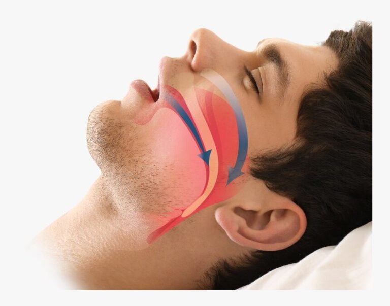 Obstructive sleep Apnea(OSA) - iLOVE DENTAL CARE